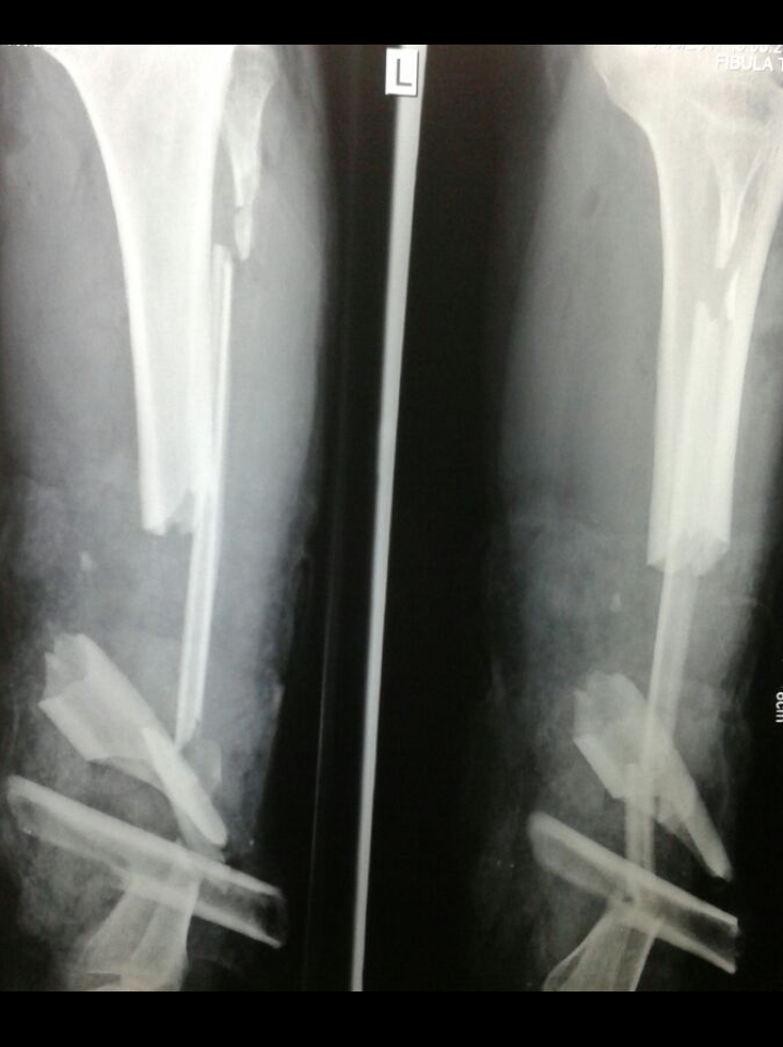Patah Tulang Kering (Tibial Bone Fracture) | hilmi muhammad